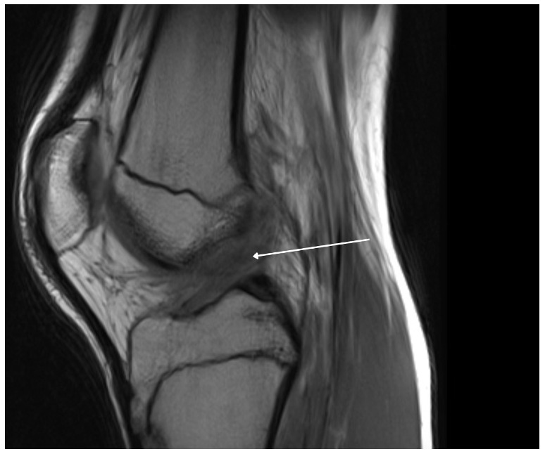 Bridged-Enhanced ACL Restoration: An Adolescent Case Report with 18 ...