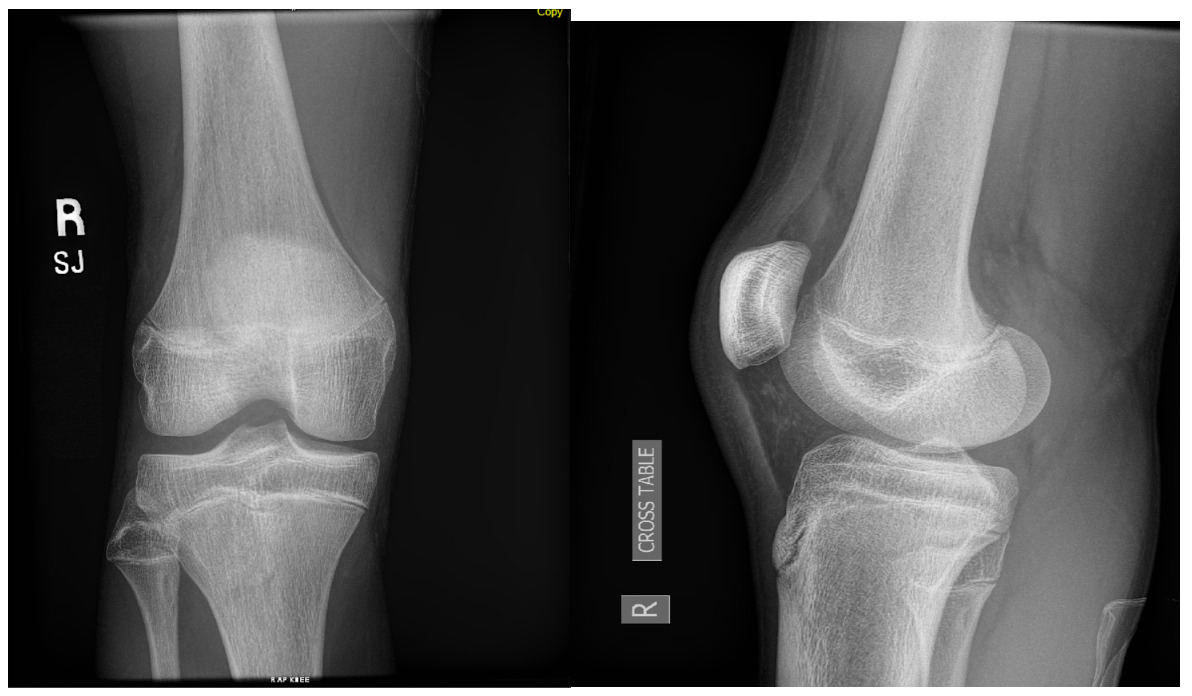 Bridged-Enhanced ACL Restoration: An Adolescent Case Report with 18 ...