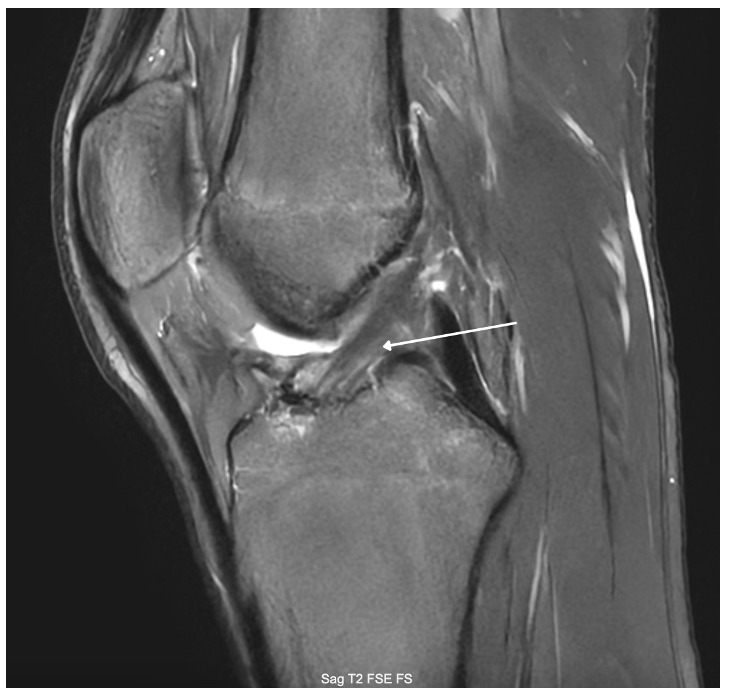 Bridged-Enhanced ACL Restoration: An Adolescent Case Report with 18 ...